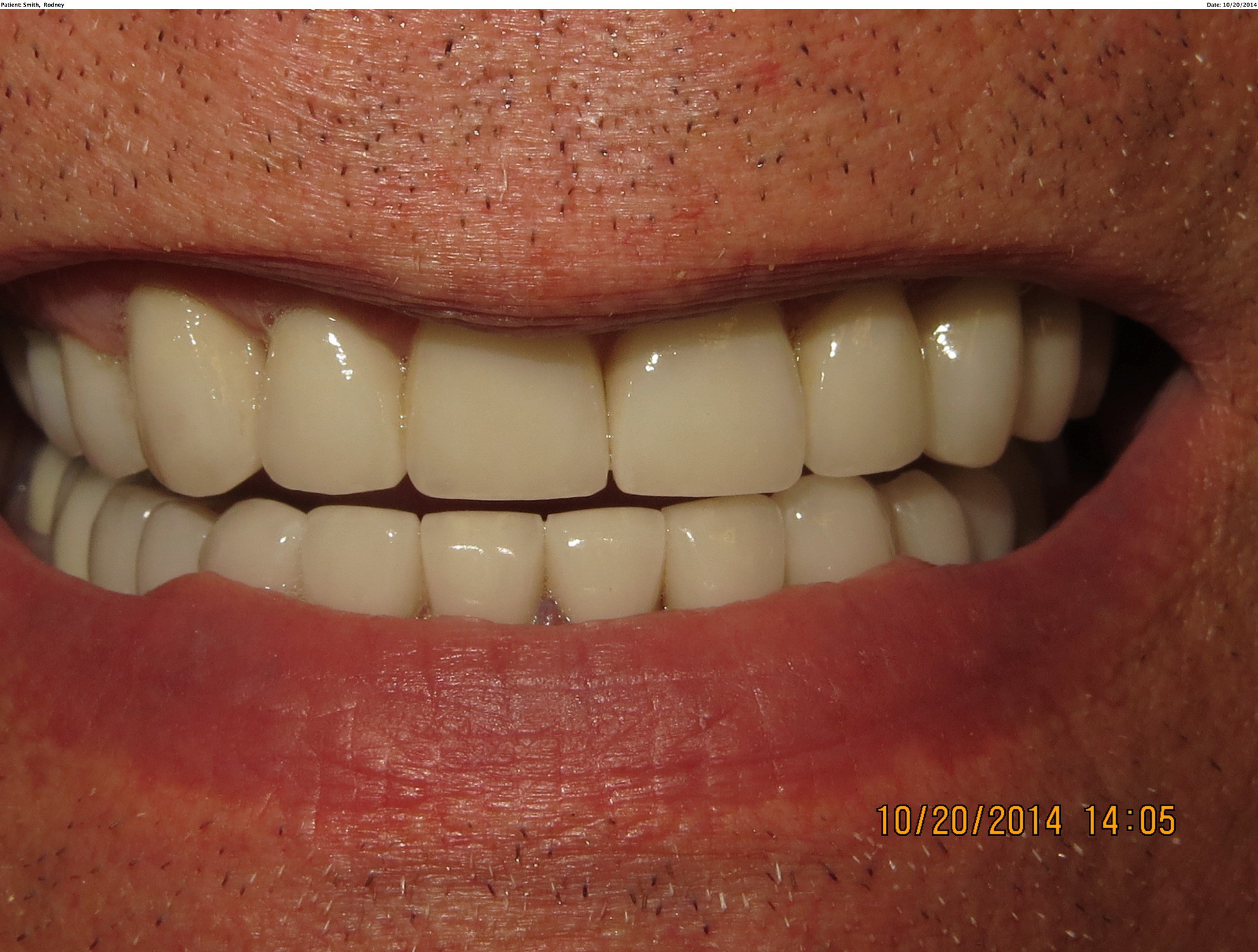 Crown Lengthening Dallas TX
