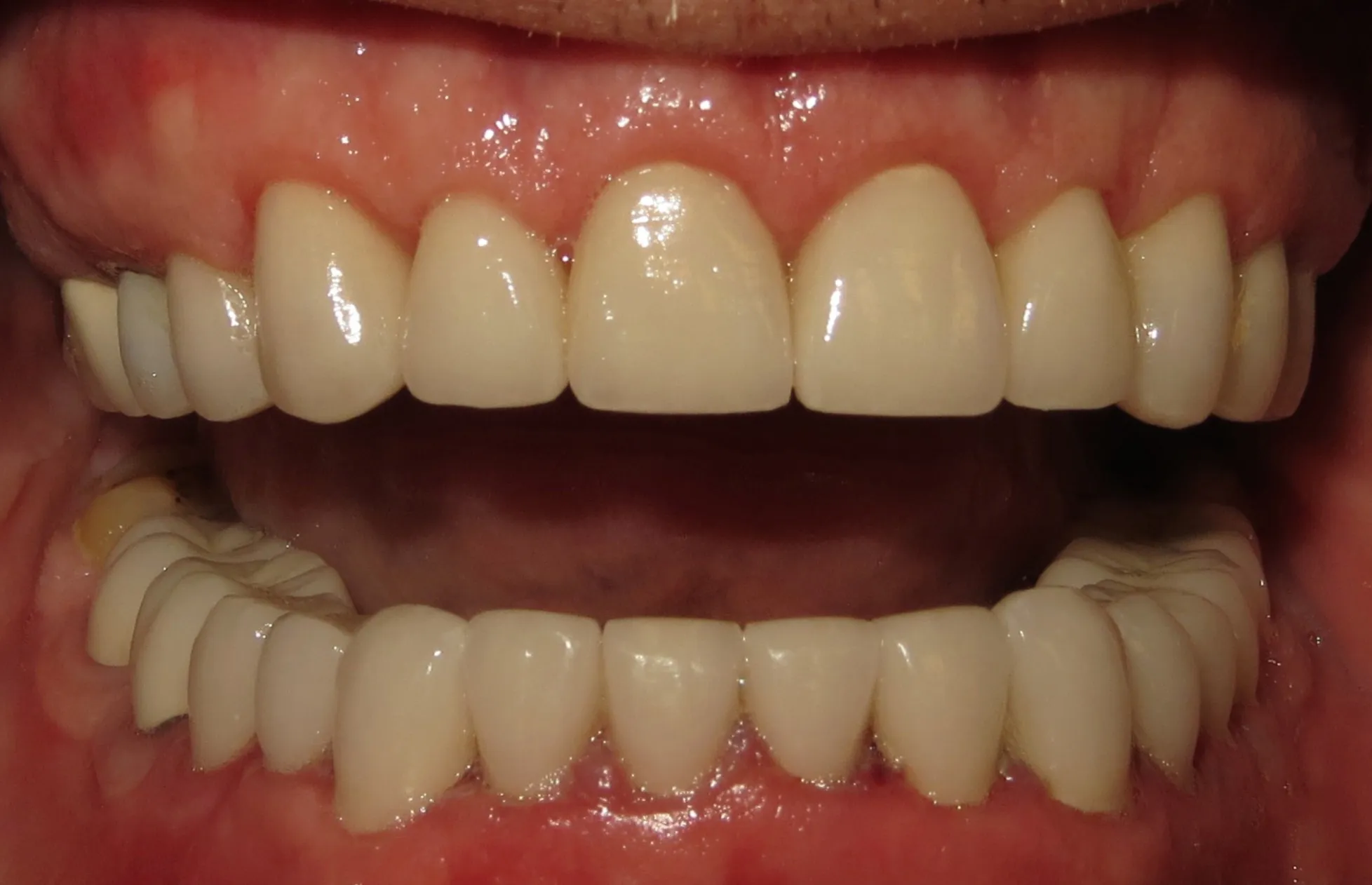 Crown Lengthening Dallas TX